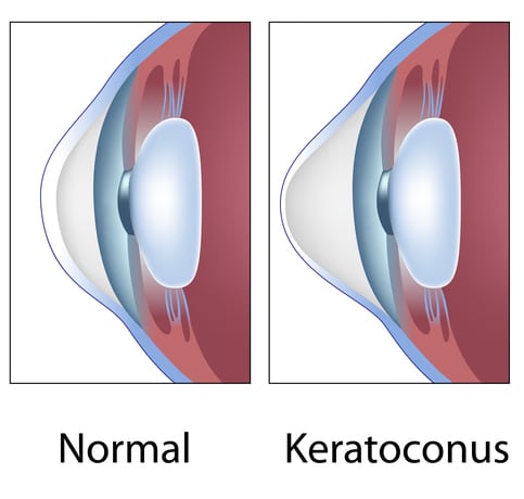 Keratoconus Griffin | Corneal Transplant Locust Grove