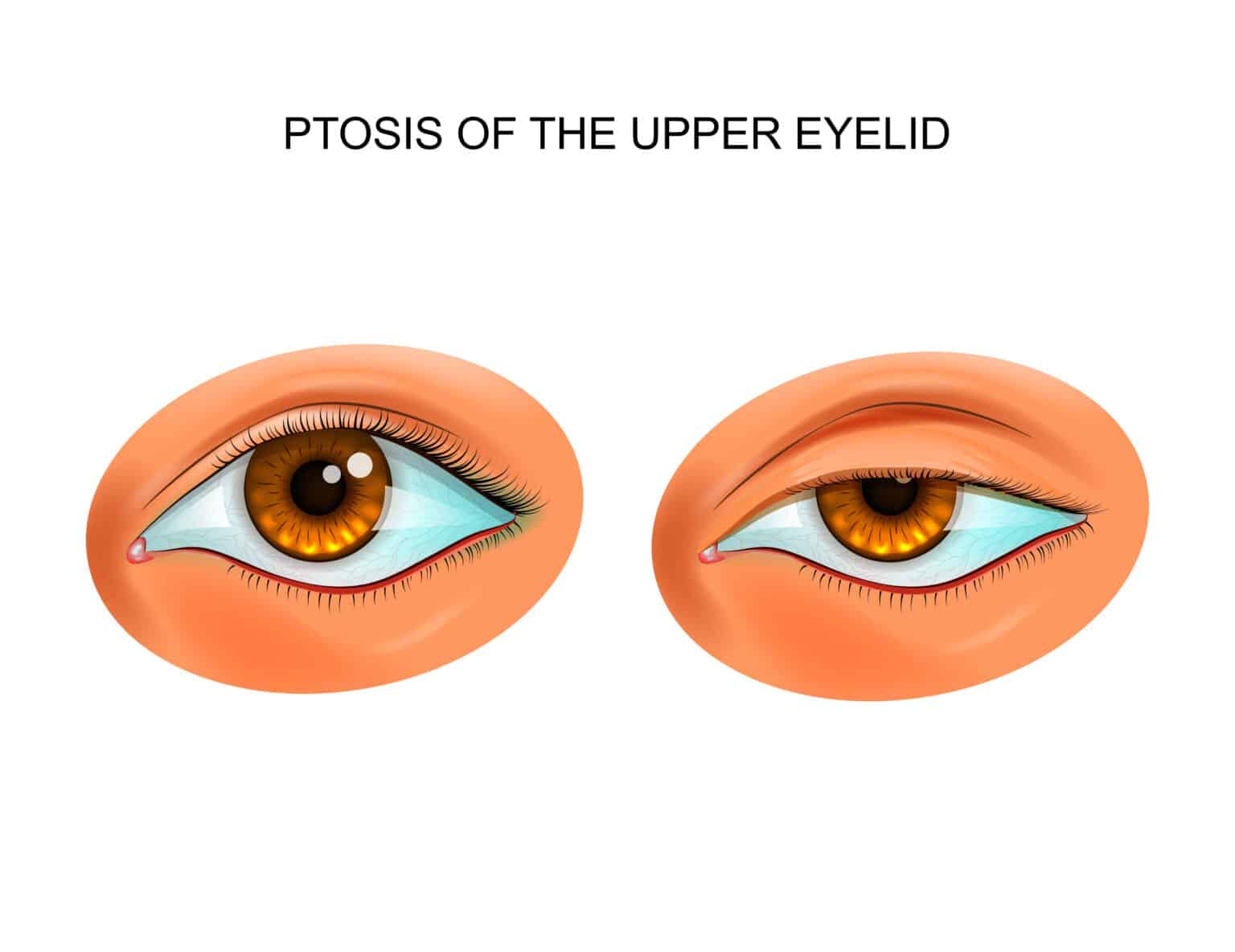 What is Ptosis? | Ptosis Griffin, GA | Ptosis Locust Grove | Takle Eye ...