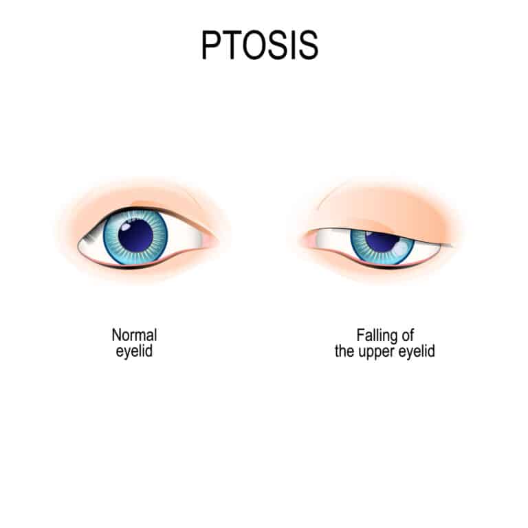What is Ptosis? | Ptosis Griffin, GA | Ptosis Locust Grove | Takle Eye ...