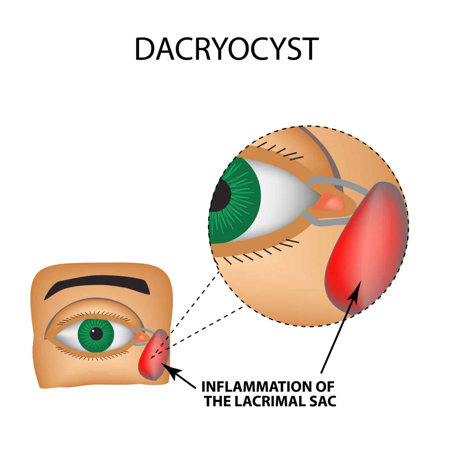 What are Tear Duct and Eye Socket Disorders? | Takle Eye Group